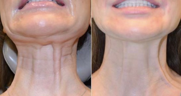 Before & After Dallas, TX - ROOT Med Spa - Elevate Your Wellness Journey