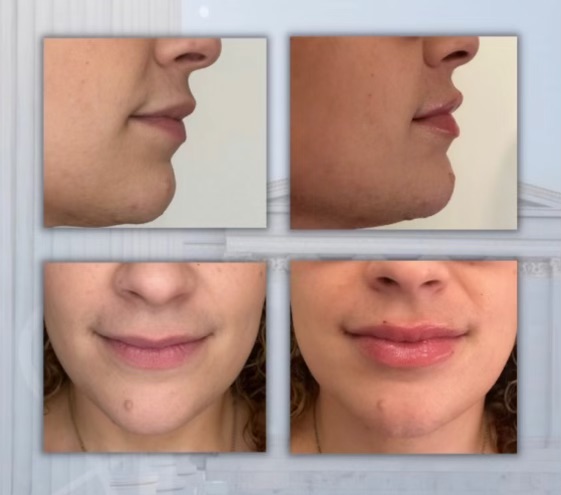 Before & After Dallas, TX - ROOT Med Spa - Elevate Your Wellness Journey